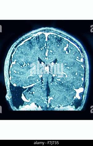 HEMORRHAGE, BRAIN MRI Stock Photo - Alamy