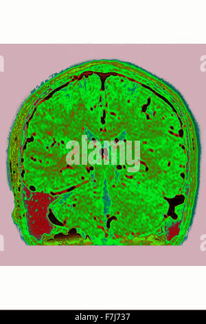 HEMORRHAGE, BRAIN MRI Stock Photo - Alamy