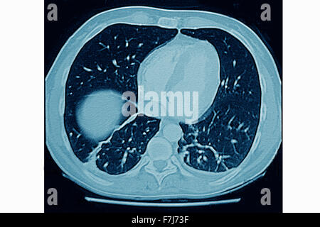 PULMONARY INFARCTION CT SCAN Stock Photo: 90755156 - Alamy