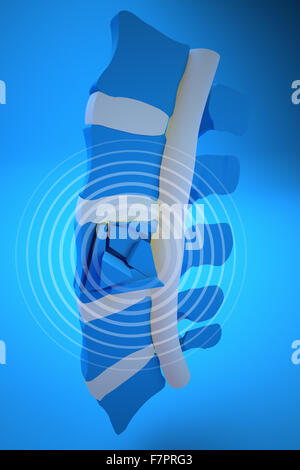 Spine, marrow, traumatic fractures vertebral, burst fracture. Spine ...