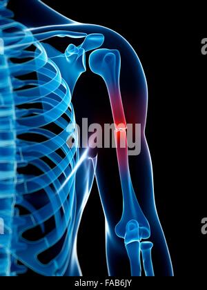 Broken upper arm bone, computer illustration Stock Photo - Alamy
