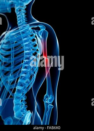Broken upper arm bone, computer illustration Stock Photo - Alamy