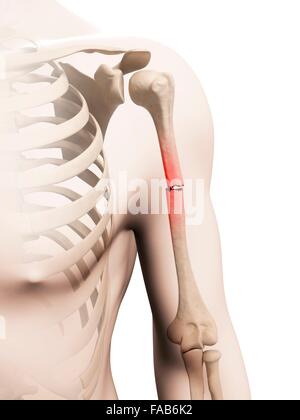 Broken upper arm bone, computer illustration Stock Photo - Alamy