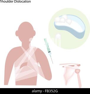 Shoulder dislocation. humerus bone trauma, Sports injuries, or Weak ...