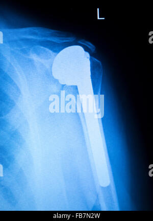 Shoulder injury titanium implant orthopedics xray scan Trauamtology ...