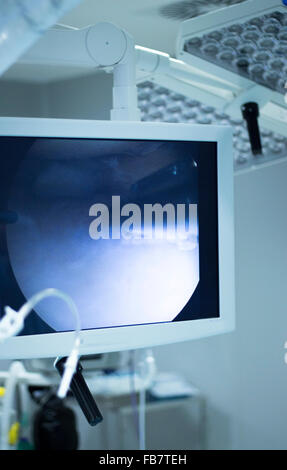 Hospital keyhole micro surgery arthroscopy operation screen showing ...
