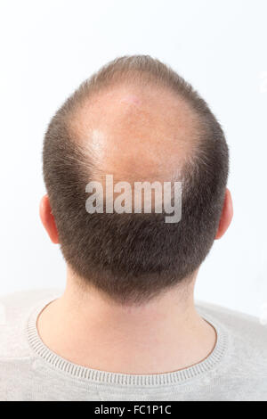 Close-up spot baldness. Alopecia Areata Stock Photo - Alamy