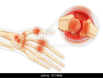RHEUMATOID ARTHRITIS, DRAWING Stock Photo - Alamy