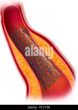 Arterial stent, illustration Stock Photo - Alamy