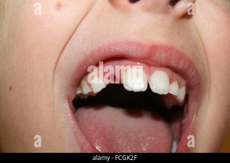 Mouth and smile of a child without one tooth. Loss of milk teeth in ...