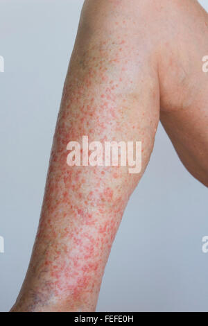 Woman's lower legs exhibiting the itchy rash associated with a severe ...