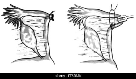 FALLOPIAN TUBE SURGERY, DRAWING Stock Photo - Alamy