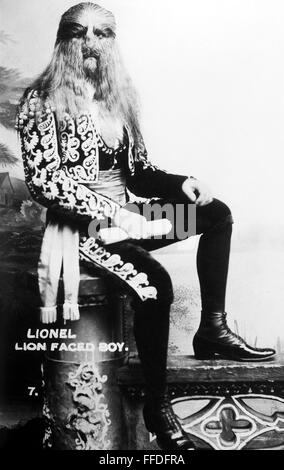 Lionel, The Lion-faced Boy Stock Photo - Alamy