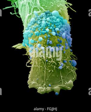 Skin cancer cell, coloured scanning electron micrograph (SEM). Cultured ...