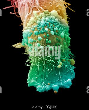 Skin cancer cell, coloured scanning electron micrograph (SEM). Cultured ...