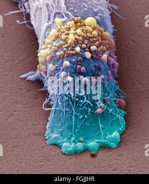Skin cancer cell, coloured scanning electron micrograph (SEM). Cultured ...
