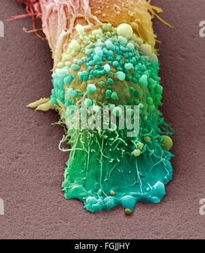 Skin cancer cell, coloured scanning electron micrograph (SEM). Cultured ...