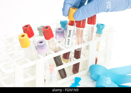 Prostate specific antigen PSA blood culture sample collection tube ...