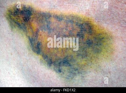 This close-up shows the multicolored effects of a body bruise on the ...