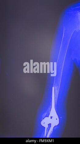 Elbow, arm and forearm orthopedic titanium metal replacement implant ...