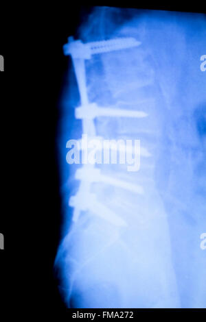 Spine, back and neck orthopedic titanium metal spinal plate brace and ...
