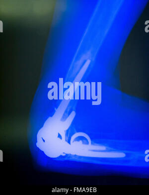 Elbow, arm and forearm orthopedic titanium metal replacement implant ...
