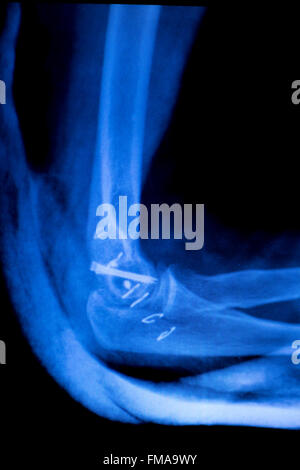 Elbow, arm and forearm orthopedic titanium metal replacement implant ...