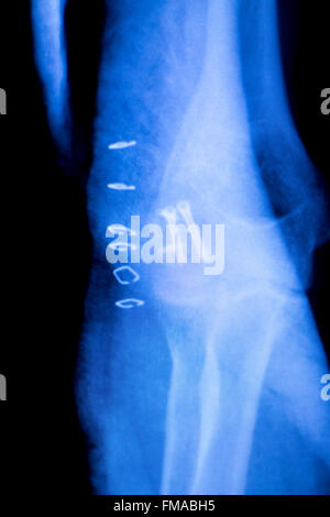Elbow, arm and forearm orthopedic titanium metal replacement implant ...