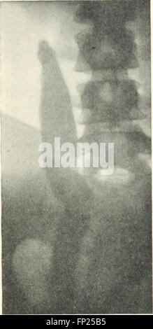 This 1915 work explores the therapeutic uses of radiography, X-rays ...