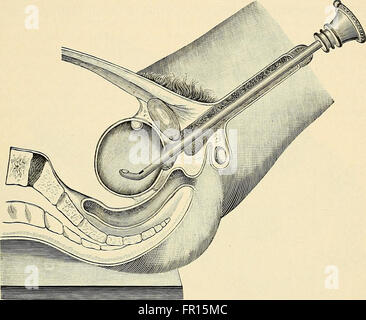 A system of genito-urinary diseases, syphilology and dermatology (1893 ...