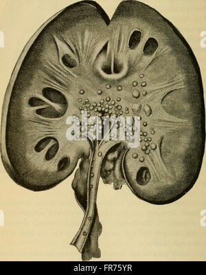 A system of genito-urinary diseases, syphilology and dermatology (1893 ...