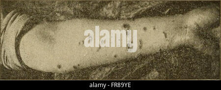 A manual of syphilis and the venereal diseases, (1900 Stock Photo - Alamy