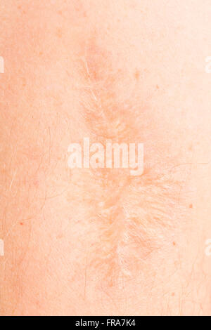 Arm with big scar Close up Man Angioma health medicine Stock Photo - Alamy