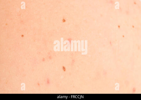 acne on male man back Stock Photo - Alamy