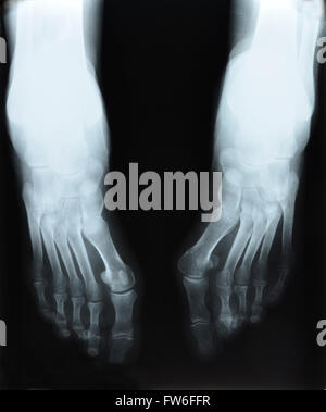 Foot and toes injury x-ray scan orthopedics and Traumatology radiology ...