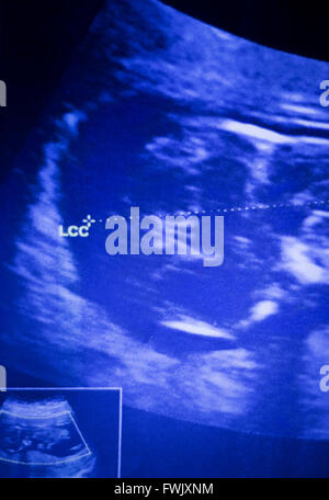 Ultrasound foetus 3 month pregnant woman's womb pregnancy scan of ...