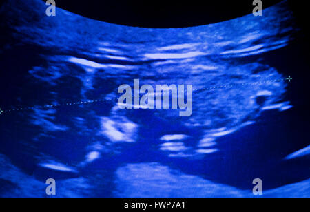 Ultrasound foetus 3 month pregnant woman's womb pregnancy scan of ...