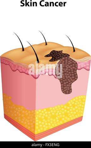 metastasis of skin cancer. malignant melanoma. The most common places for melanoma to spread ...