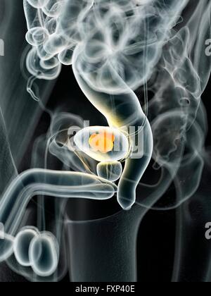 Bladder cancer, illustration Stock Photo - Alamy