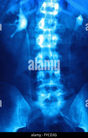 NEPHRITIC COLIC, X-RAY Stock Photo - Alamy