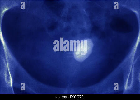 VESICAL CALCULUS, X-RAY Stock Photo - Alamy