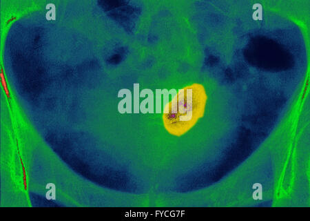 VESICAL CALCULUS, X-RAY Stock Photo - Alamy