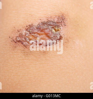 wound on skin Stock Photo - Alamy