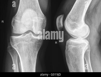 Healthy knee, X-ray Stock Photo - Alamy