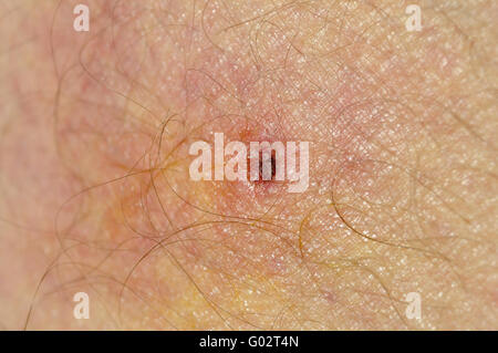 Entzuendeter Zeckenbiss infected tick bite on thigh Stock Photo - Alamy