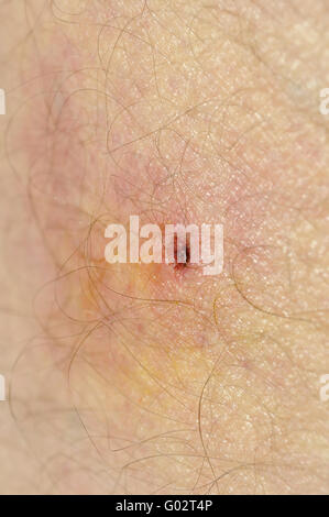 Entzuendeter Zeckenbiss infected tick bite on thigh Stock Photo - Alamy