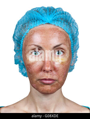 Chemical peeling. Parchment skin before rejecti Stock Photo - Alamy