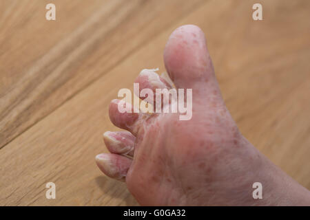 Hand foot and mouth disease. Close-up of vesicles underneath the tongue ...