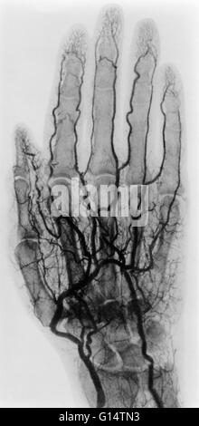 Arteriogram of a hand. The radial artery can be seen in the lower left ...