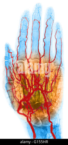 Arteriogram of a hand. The radial artery can be seen in the lower left ...